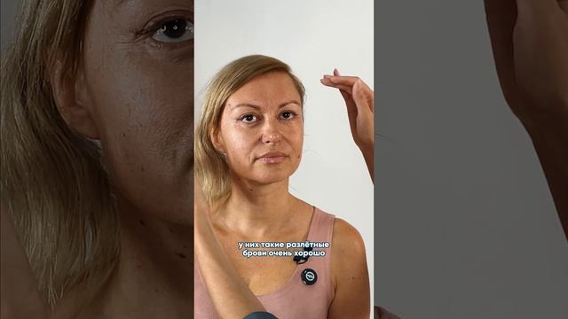 Ирина Леонидовна о результате периорбитопластики через 1 год