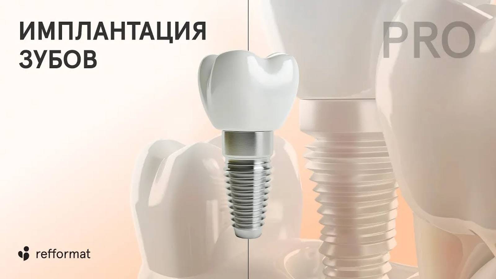 🔎 Имплантация All-on-4 и All-on-6