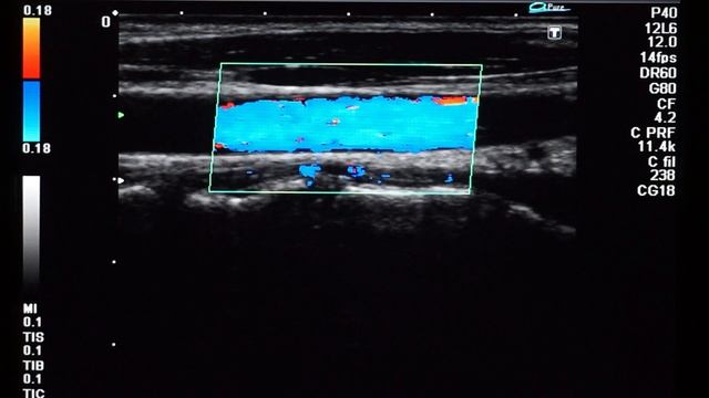 Toshiba Nemio MX обзор ультразвукового сканера
