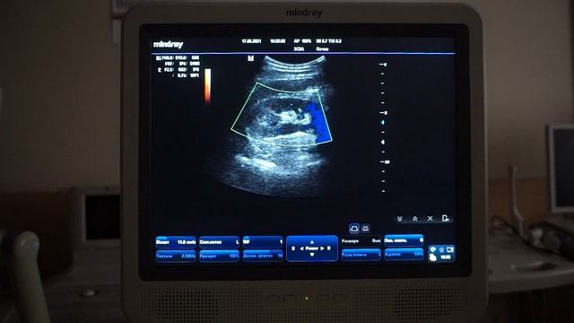 Mindray DC-3 обзор ультразвукового сканера