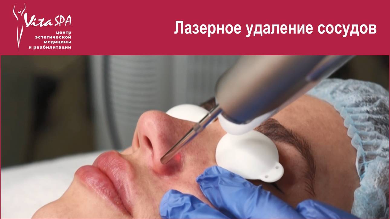 Лазерное удаление сосудов