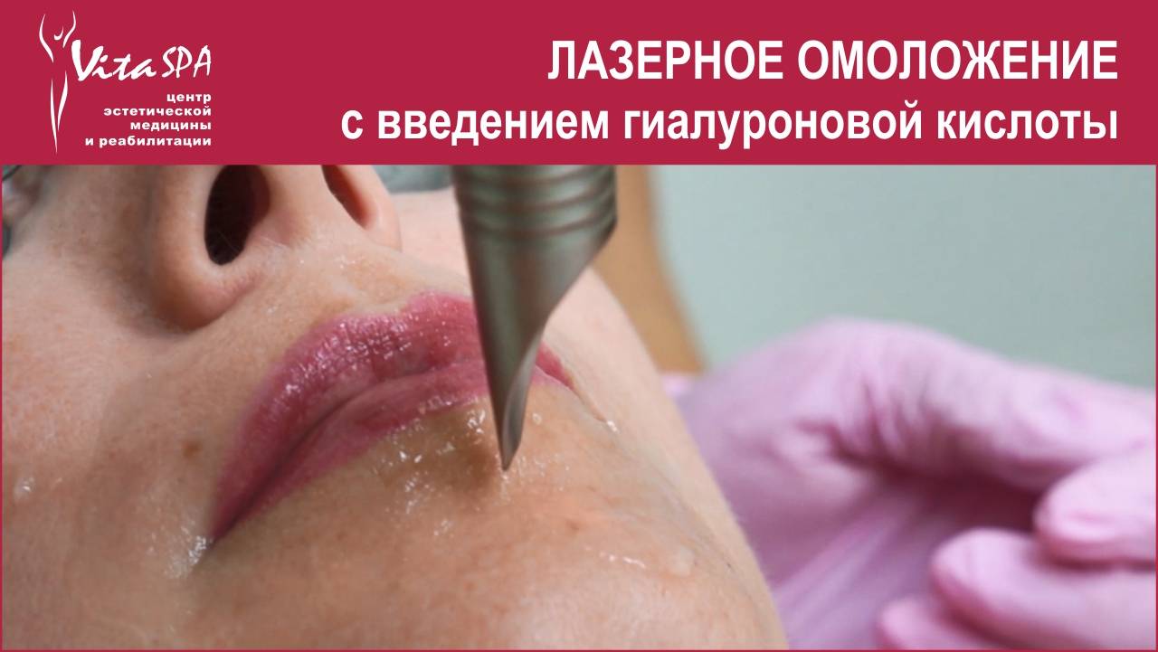 ВитаСПА Лазерное омоложение с введением гиалуроновой кислоты