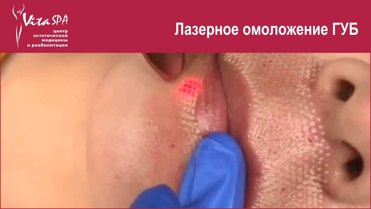 Лазерное омоложение губ