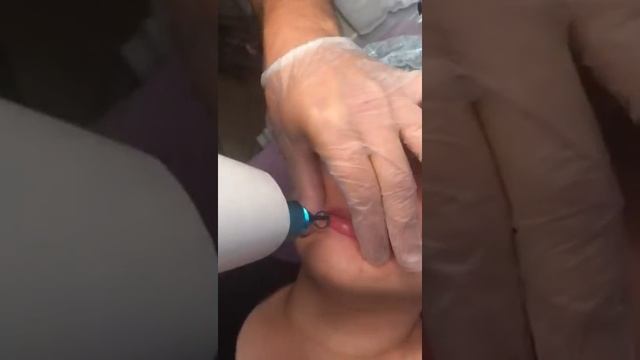 Удаление татуажа губ