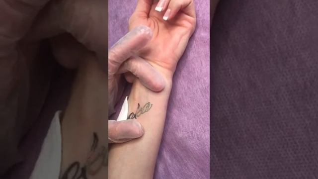 Удаление тату на предплечье