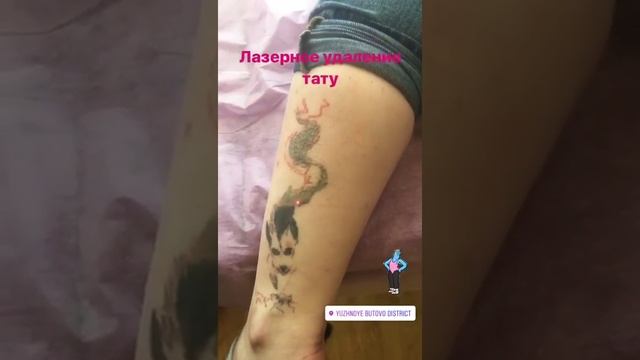 Удаление тату на ноге