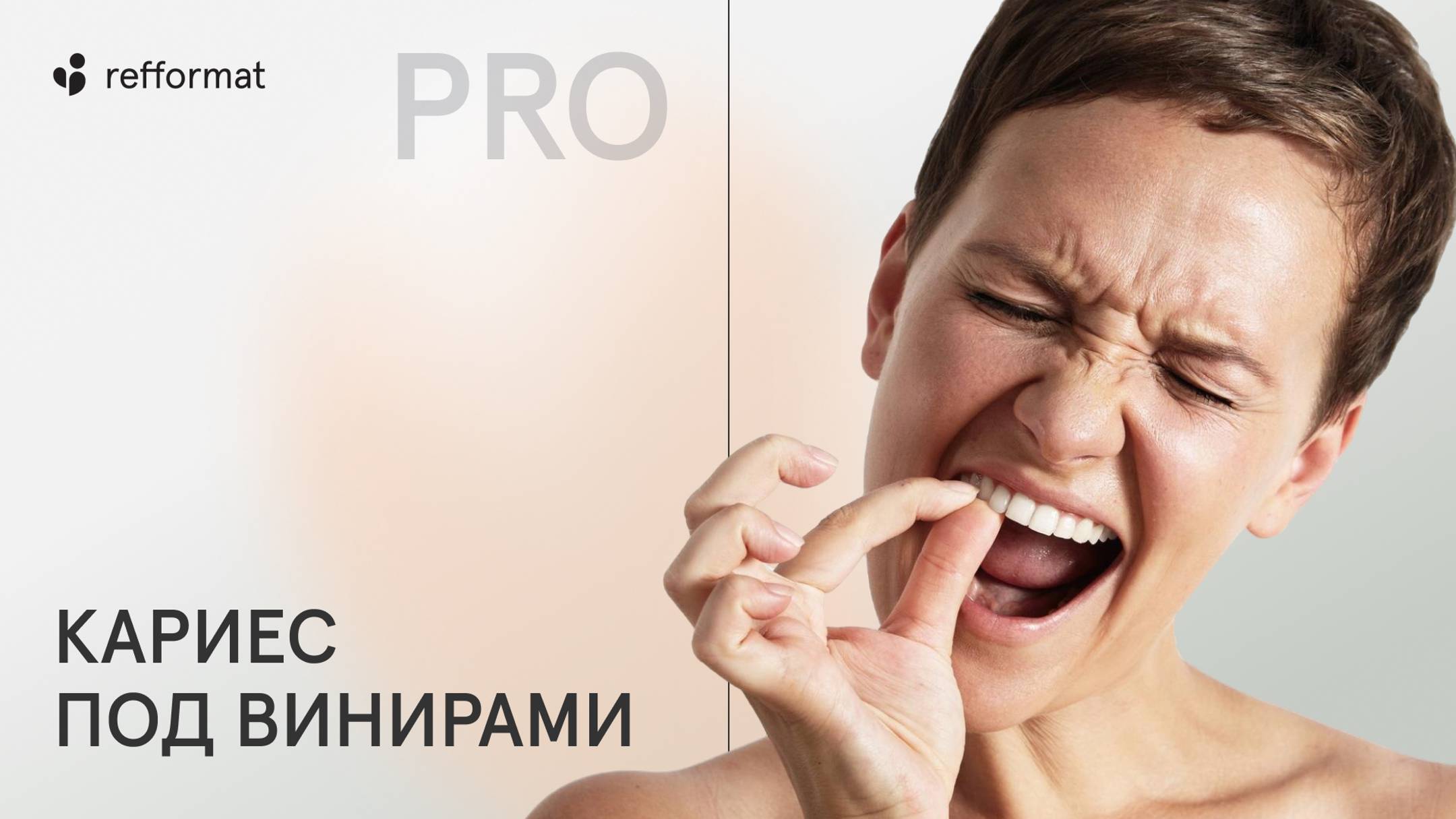 🧐 Кариес под винирами: бывает ли и как лечить?