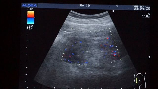 Aloka SSD-3500 обзор ультразвукового сканера