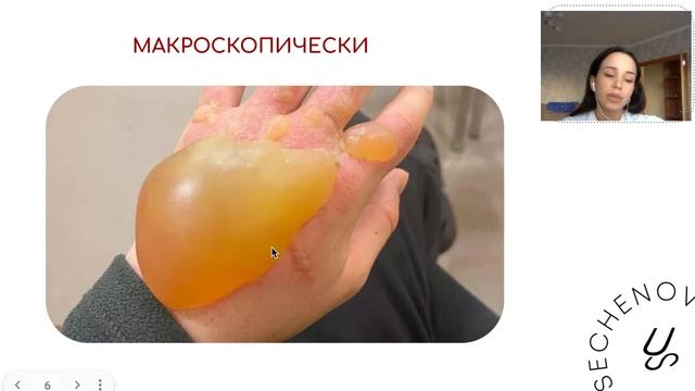 Патологическая анатомия | Серозное воспаление