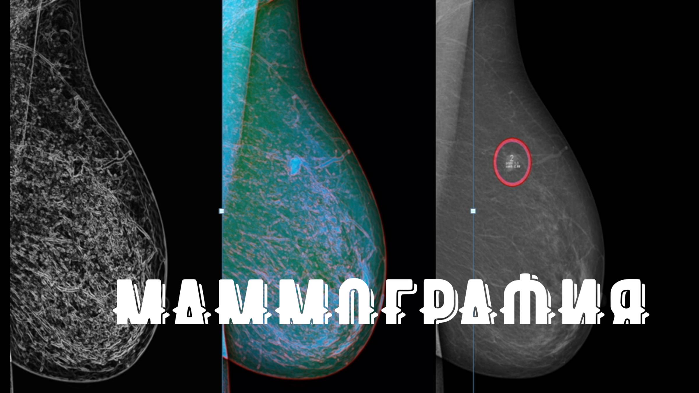 Mammography BI RADS МУСТАФИН ЧИНГИС 79104653497 КУРС МАММОЛОГИИ
