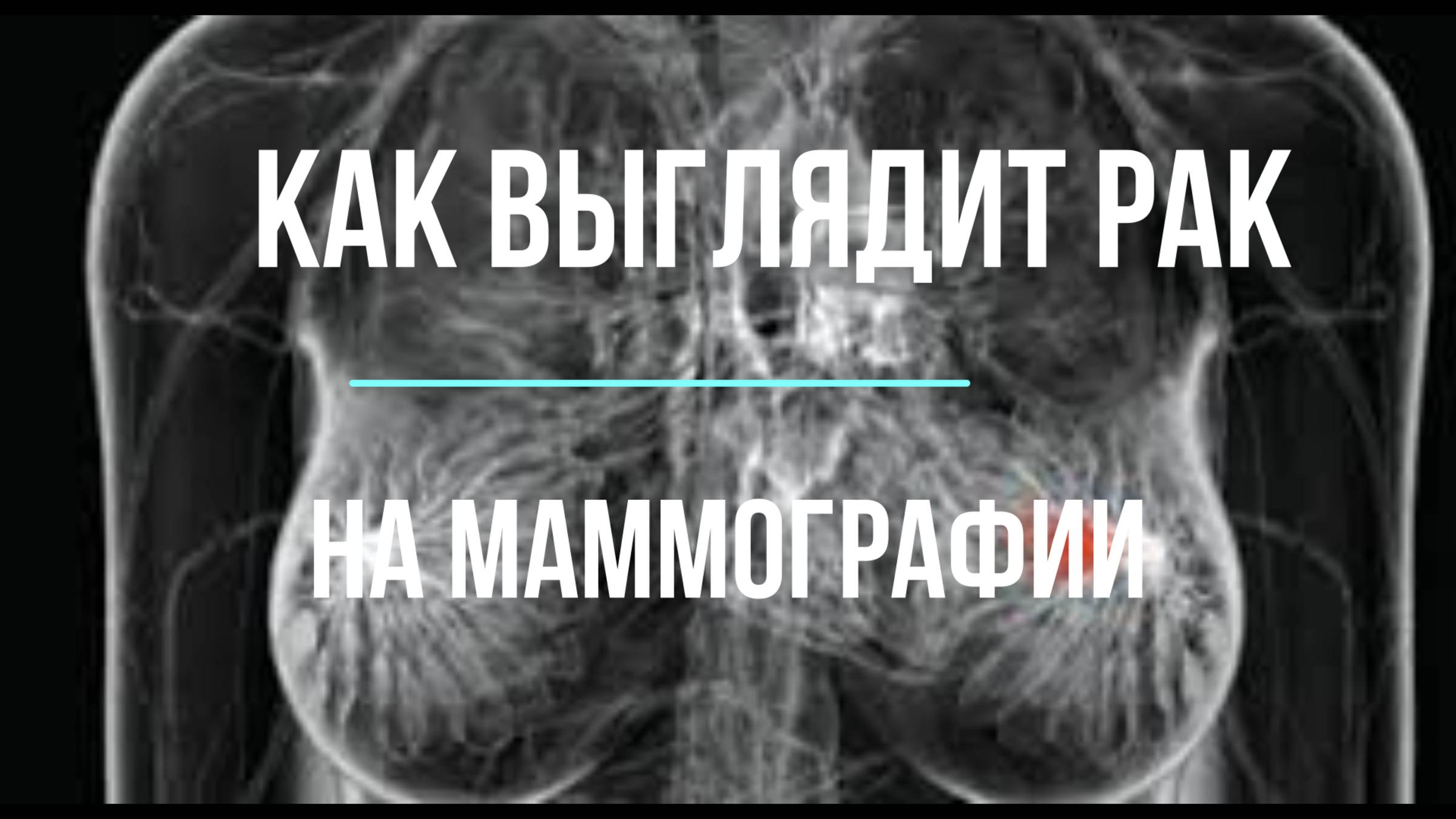 РАК НА МАММОГРАФИИ. ПРИЗНАКИ. МУСТАФИН ЧИНГИС 79104653497 КУРС МАММОЛОГИИ
