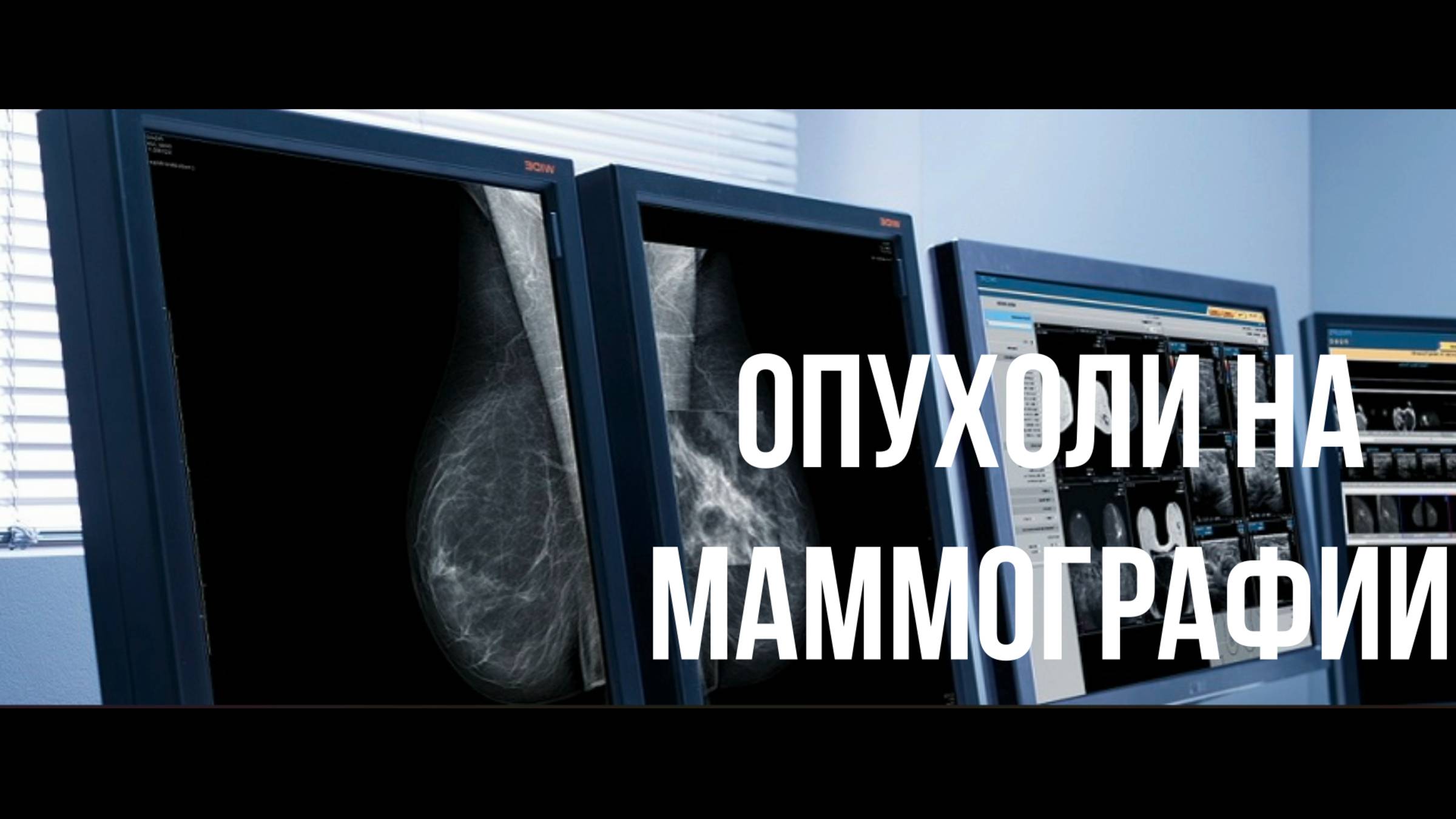 КАК ВЫГЛЯДЕТ РАК НА МАММОГРАФИИ. КУРС МАММОЛОГИИ МУСТАФИН ЧИНГИС 79104653497