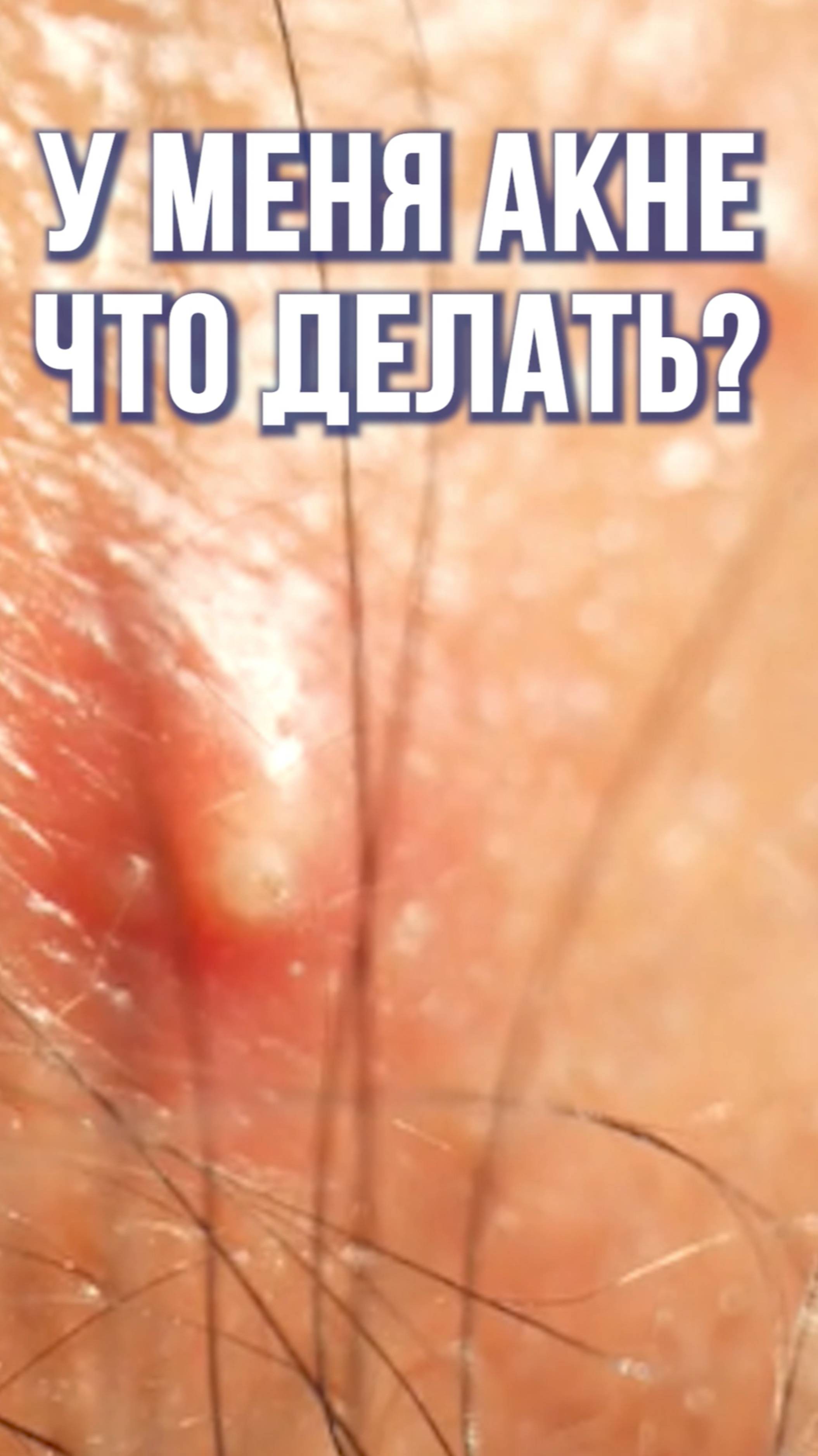 Что делать, если у вас акне? Полное видео уже на канале: https://rutube.ru/video/c20e7f70ef1b76