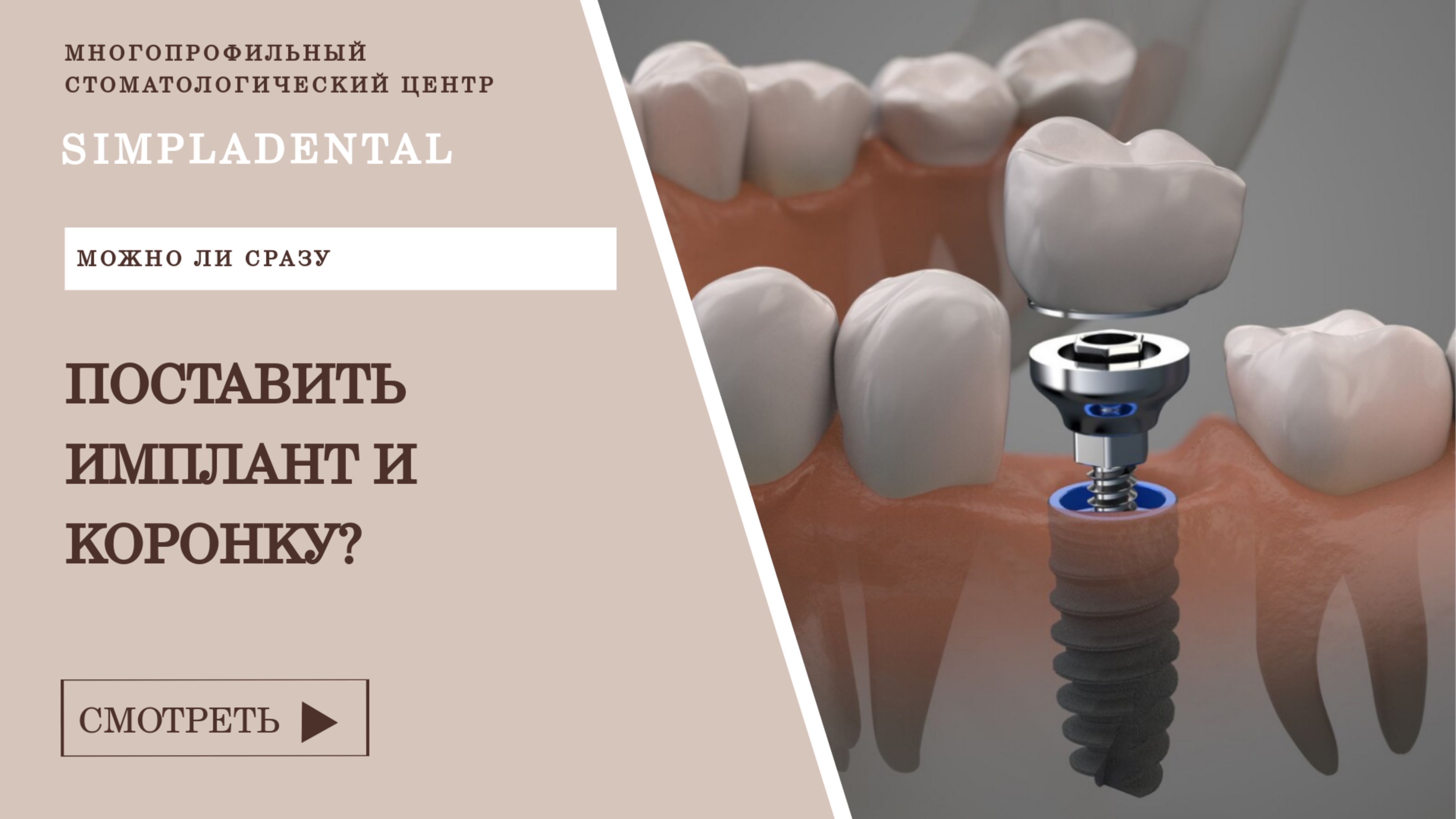 Можно ли удалить зуб и сразу поставить имплантат и коронку?