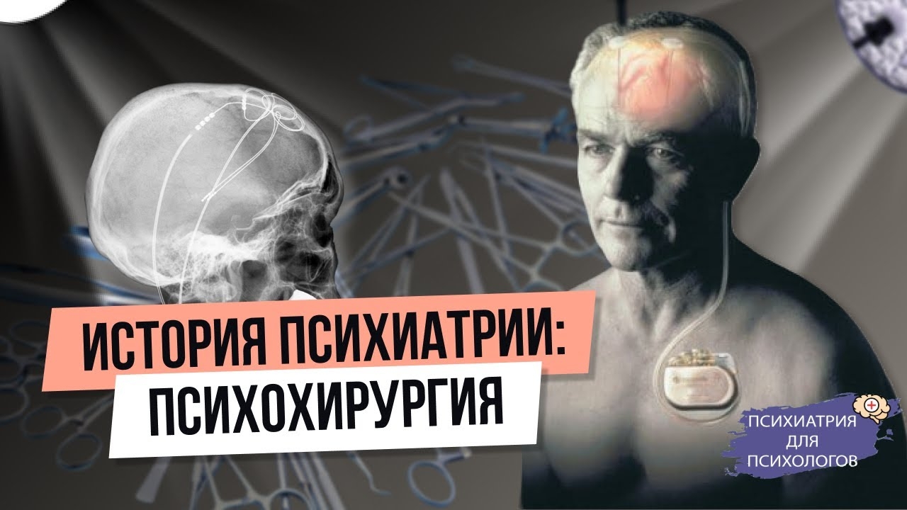 История психиатрии. Психохирургия.