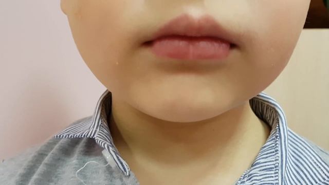 Как определить длину уздечки? Короткая уздечка языка и норма