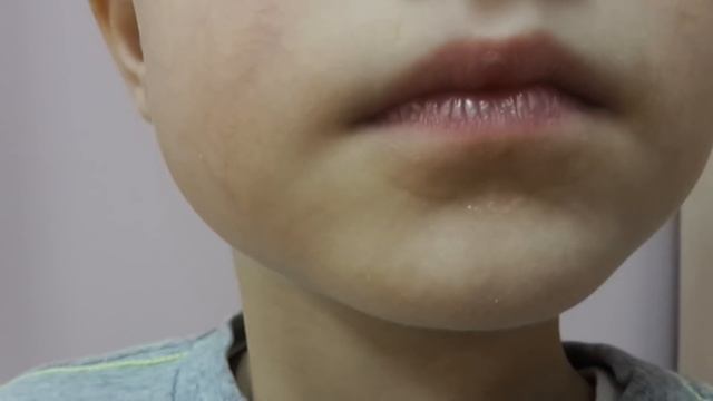 Как понять, короткая уздечка языка или нет? Дизартрия, уздечка языка и звукопроизношение.