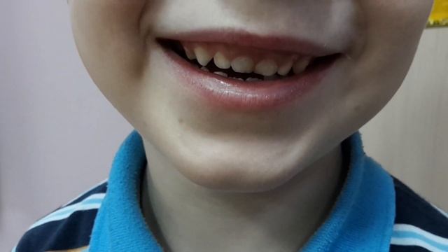 Короткая уздечка языка или короткая подъязычная уздечка.Нужно ли подрезать короткую уздечку?