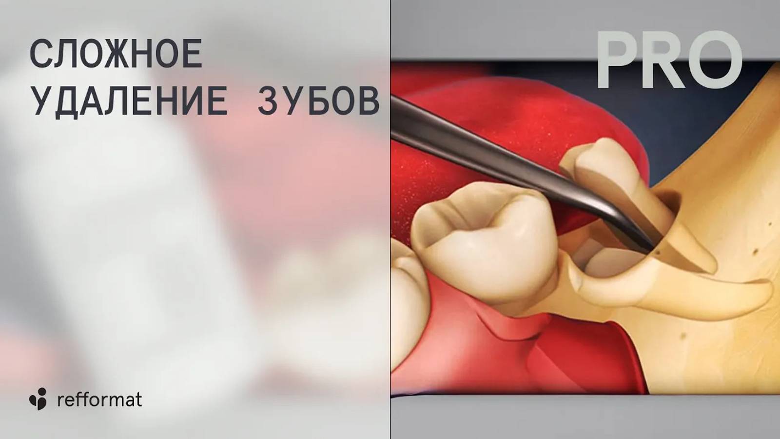 💁♂️ Что такое сложное удаление зубов?