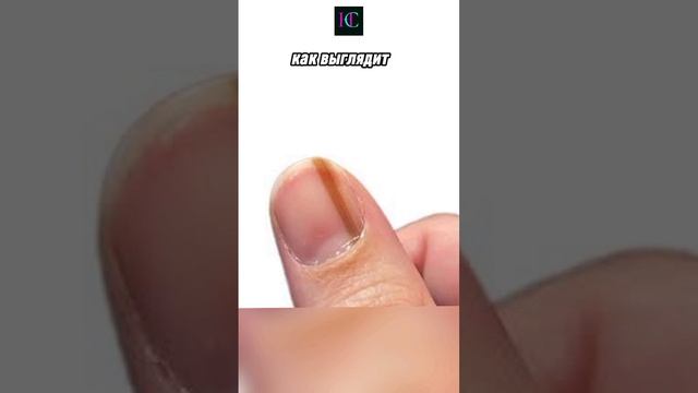 подногтевая МЕЛАНОМА