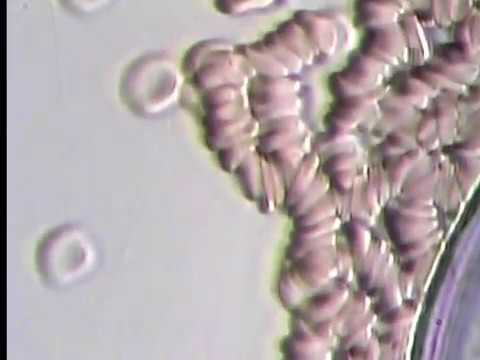 Нити фибриногена (фибрина) под микроскопом | Filaments of fibrinogen (fibrin) under the microscope