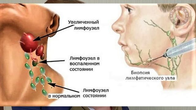 Шейный лимфаденит
