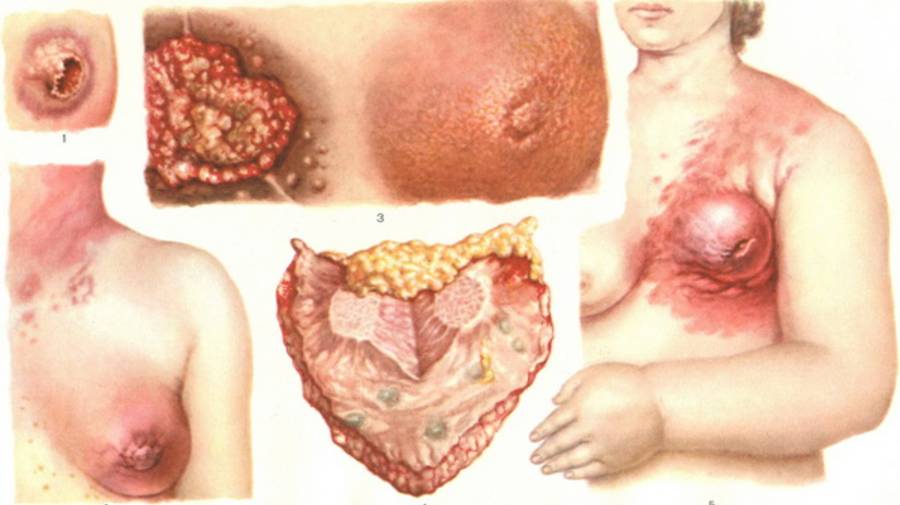 РАК 9/2 МОЛОЧНЫХ ЖЕЛЕЗ  ПРОФЕССОР КИЖАЕВ Е.В.