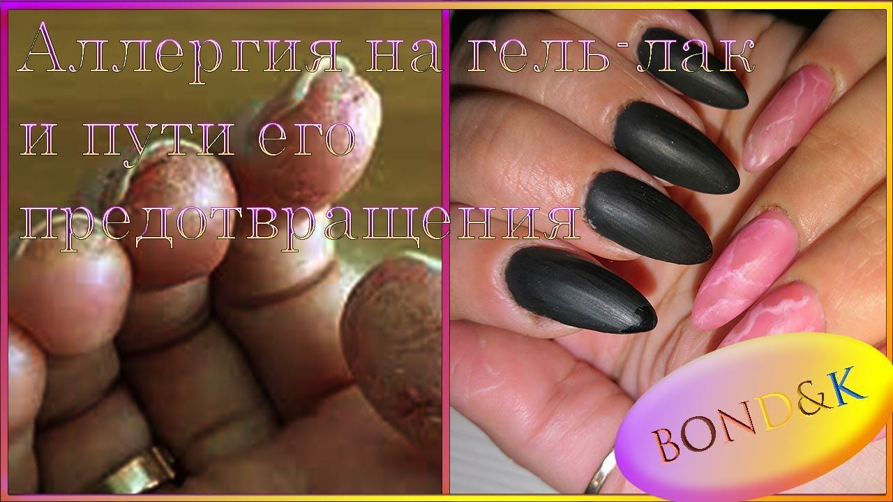 Аллергия на гель-лак. Как избавиться от аллергии на гель лак? Модный, стильный маникюр.