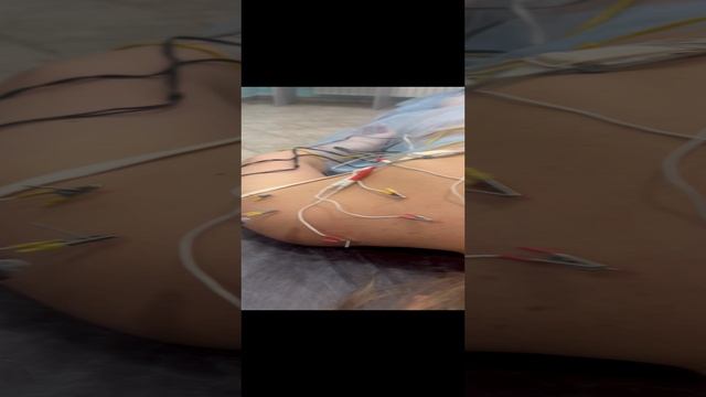 Электротермоакупунктура - сочетание игл, тока и прогревания.