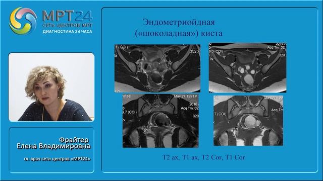 МРТ в дифференциальной диагностике кистозных образований яичников