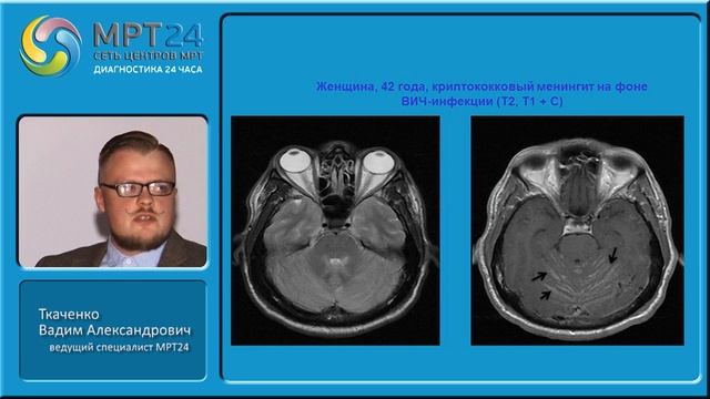 МРТ в диагностике воспалительных изменений оболочек мозга
