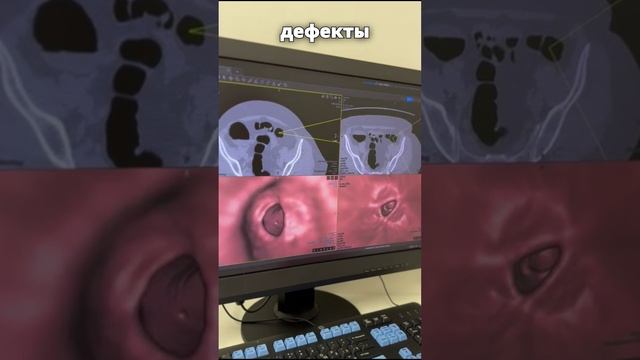 3D виртуальная колоноскопия