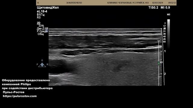 Некий очаг в щитовидной железе