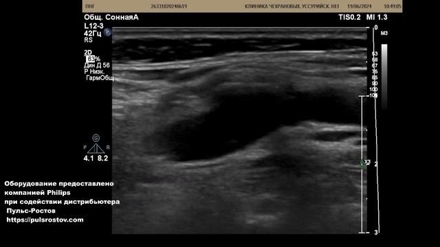 Бляшки в сосудах шеи