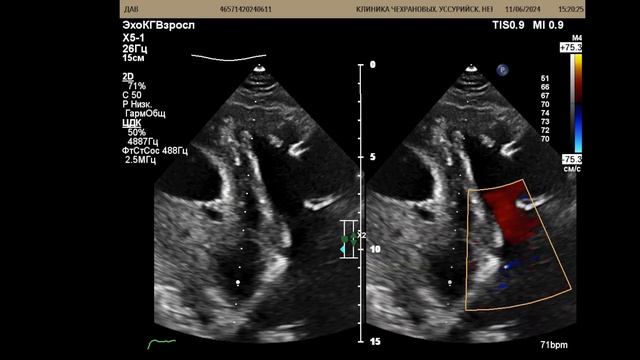 ЭХОКГ в Уссурийске для Хабаровского сердечно-сосудистого центра.