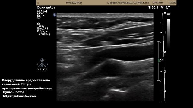 Сравнение датчиков L 12-3 и  EL 18-4 .Бифуркация сонной артерии, бляшка передней стенки
