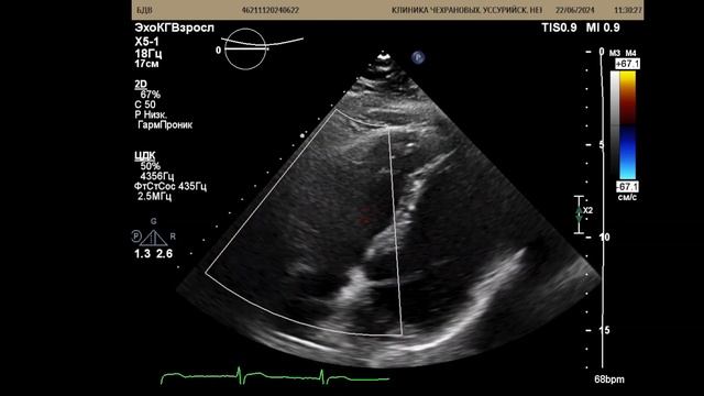УЗИ сердца 44 года.  Пока все нормально...