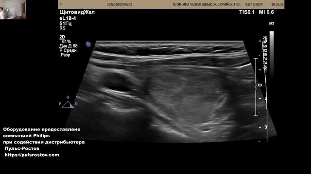 Множественные большие узлы щитовидной TIRADS 3, но один из них имеет кальцинатик...