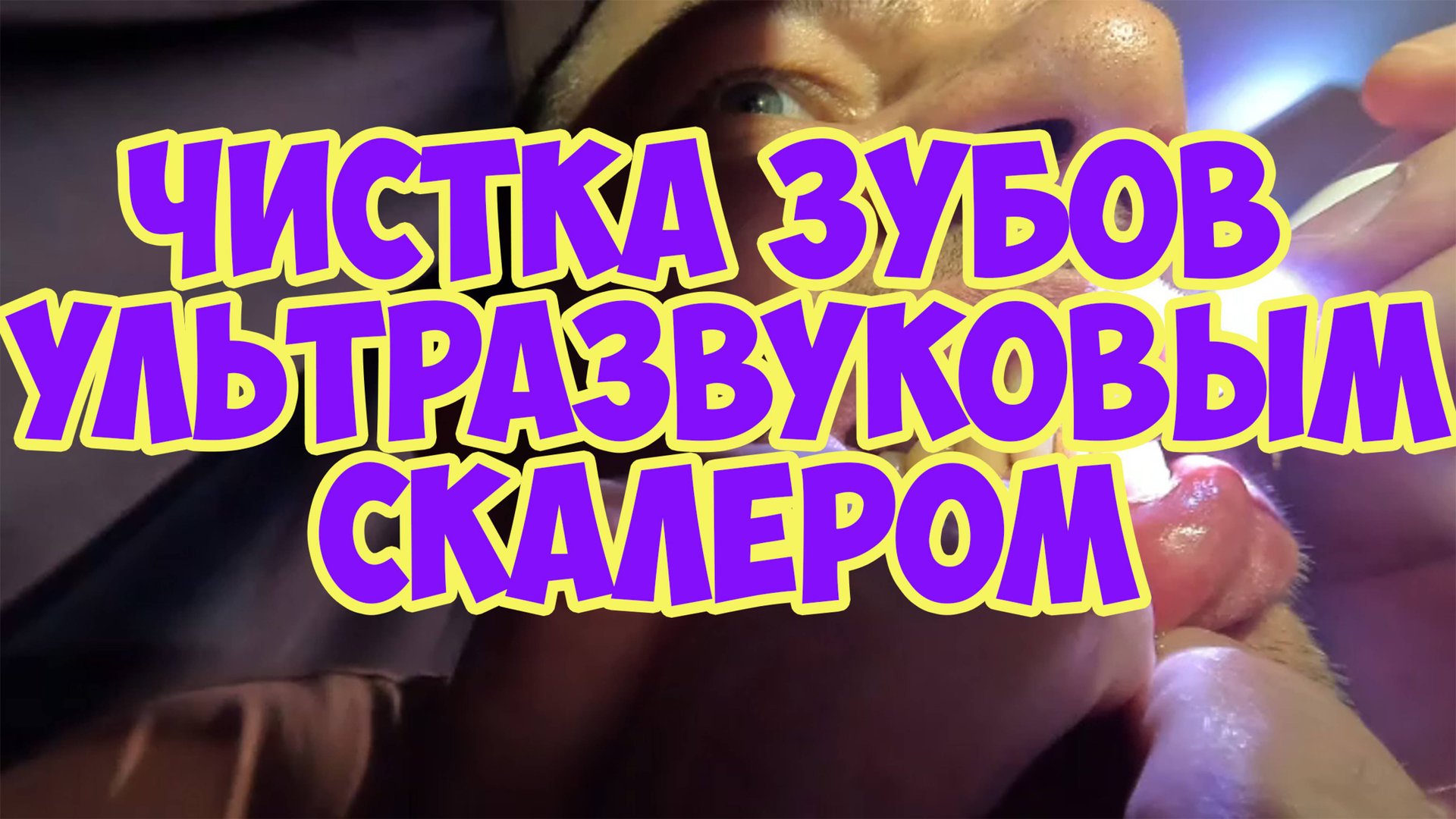 Скалер ультразвуковой для домашнего использования