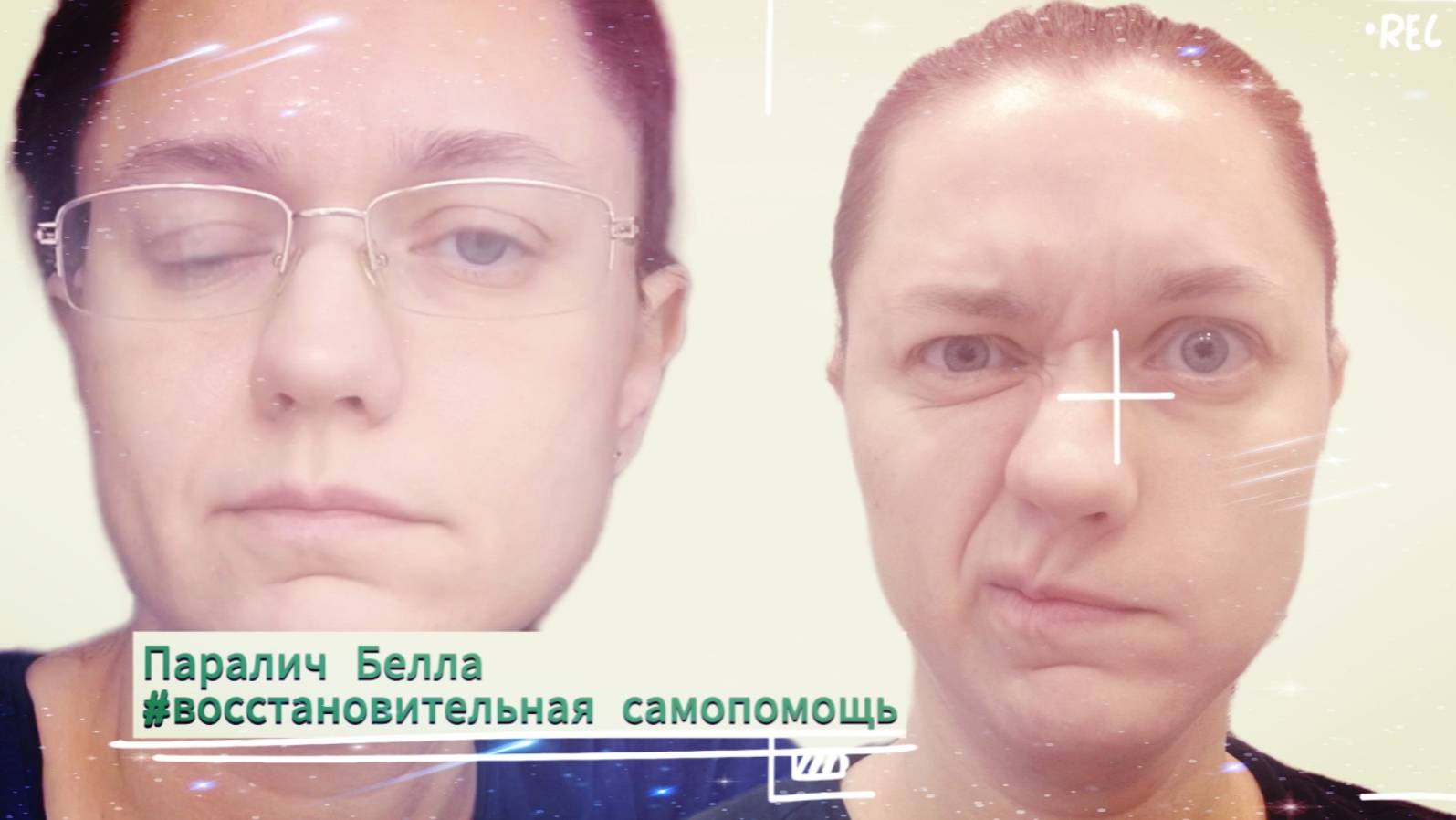 Паралич лицевого нерва (парез лицевого нерва, паралич Белла). Восстановительная самопомощь (3)