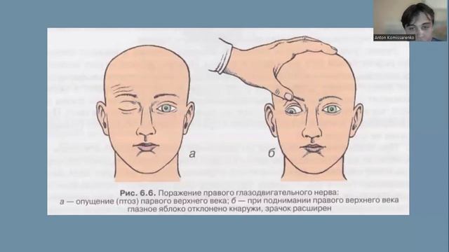 Нарушение глазодвигательных функций. Поражение глазодвигательных нервов