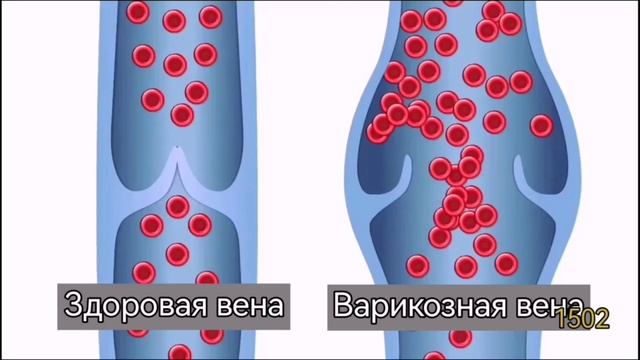 Кармановидный клапан в венах