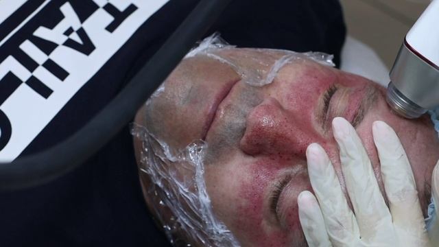 Микроигольчатый RF Infini, врач Краснова