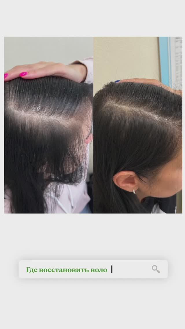 Трихология. Прием врача трихолога с трихоскопией.