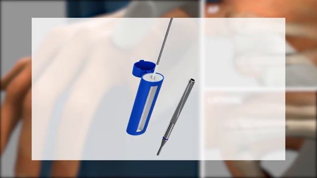 Фиксация пястных костей [get-save.com]