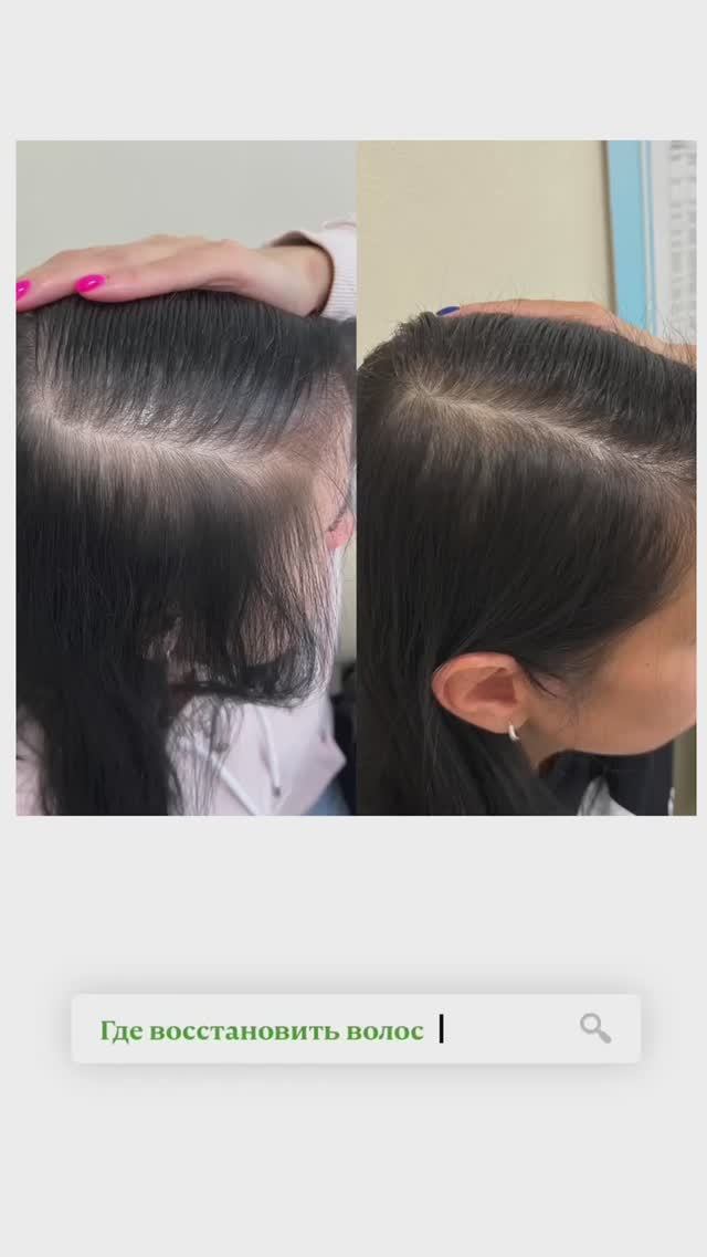 Трихология. Прием врача трихолога с трихоскопией.