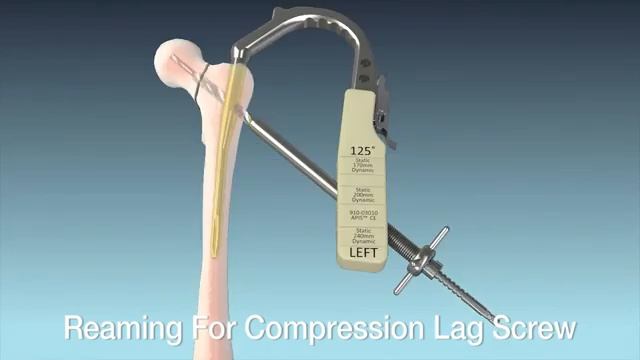 Гамма. Техника имплантации [get-save.com]