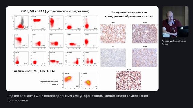 Редкие варианты ОЛ с неопределенным иммунофенотипом, особенности комплексной диагностики