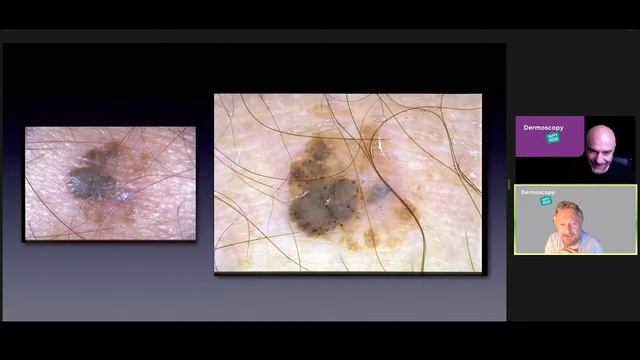 Ep.4 - MELANOMA THICKNESS with John Paoli - Dermoscopy Happy Hour