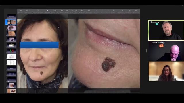 Ep.9 - NEVUS ASSOCIATED MELANOMA with Susana Puig - Dermoscopy Happy Hour